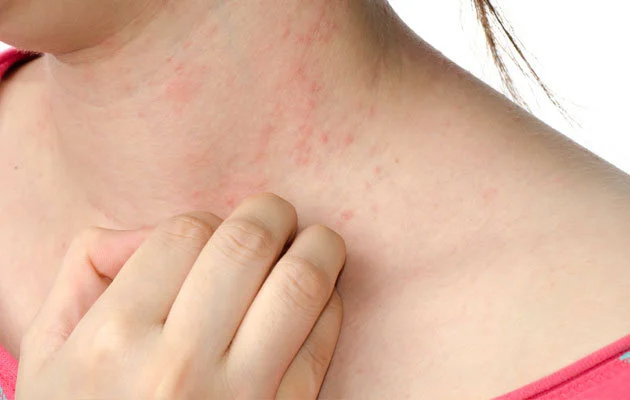 Natural Remedies for Rashes — Healthdigezt.com