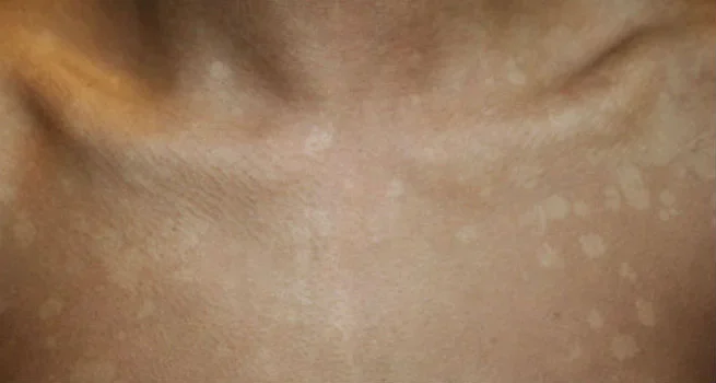 Tips on Dealing with White Spots Naturally — Healthdigezt.com