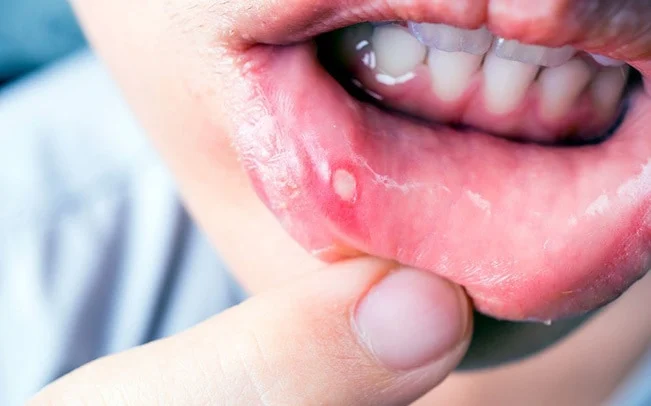 Can Athlete’s Foot Spread to Your Other Body Parts? — Healthy Builderz