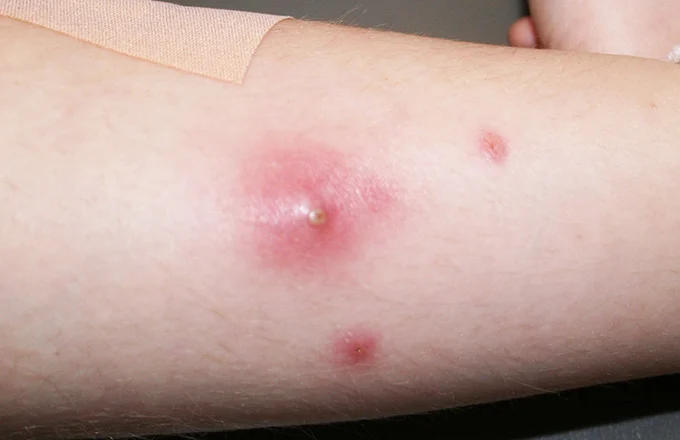 Natural Remedies for Treating Boils and Carbuncle — Healthy Builderz