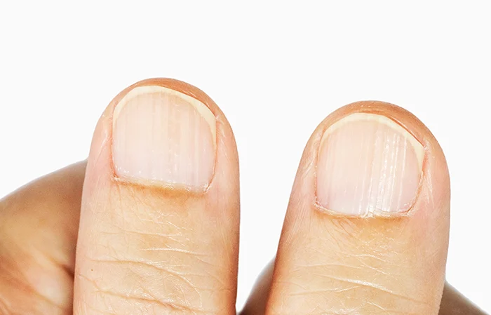 Home Remedies for Vertical Fingernail Ridges — Healthy Builderz