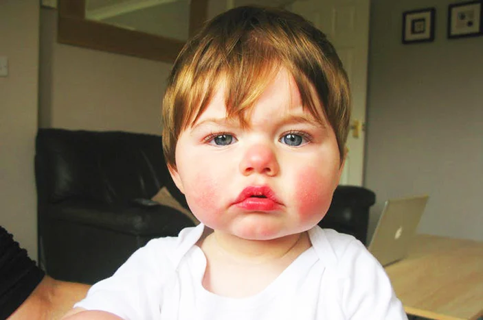 Have You Heard of Slapped Cheek Syndrome? — Healthy Builderz